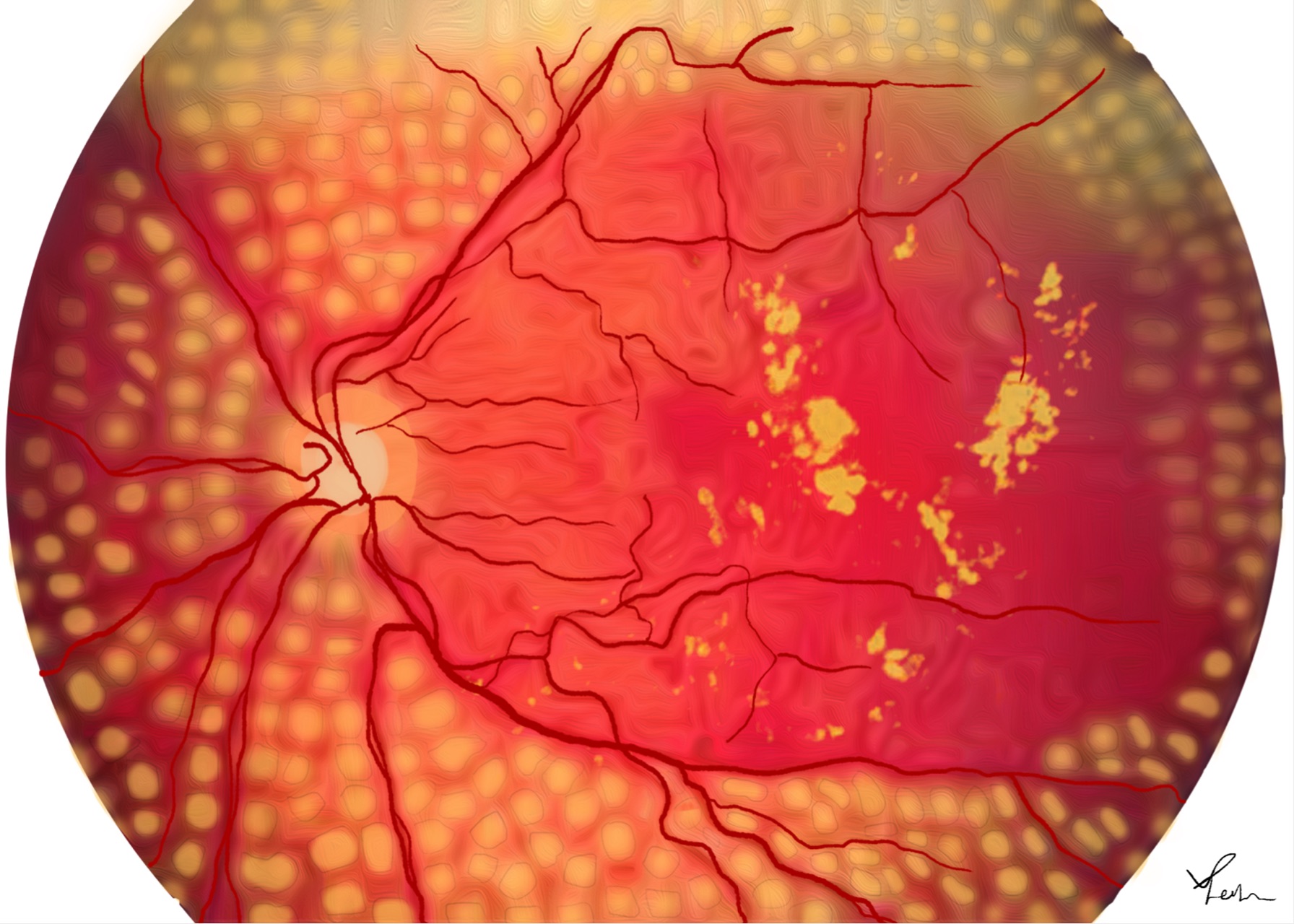 Retinal Neovascularization